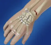 Les fractures de poignet - Chirurgie Orthopédique Côte d'Opale